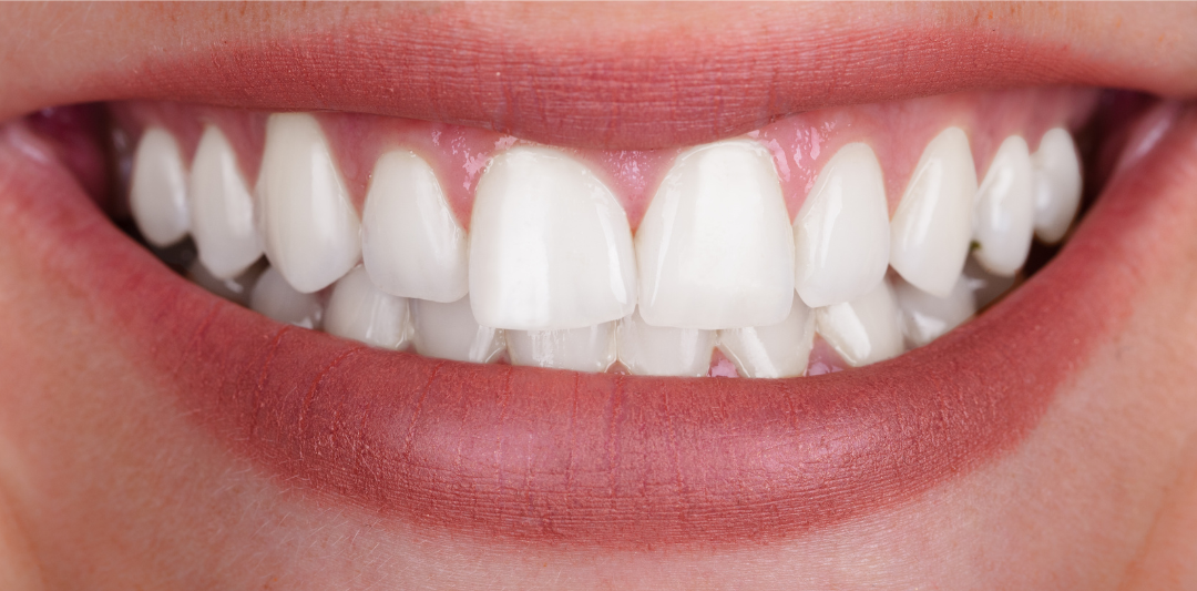 Professional teeth cleaning Bydgoszcz, Teeth Sandblasting, Polishing ...